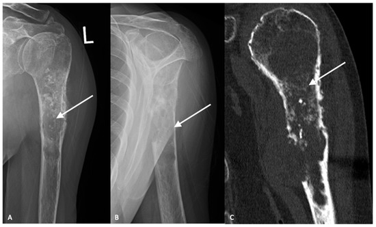 Chondrosarcoma: A Clinical Review