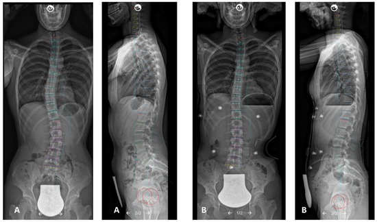 Outcome of Conservative Therapy of Adolescent Idiopathic Scoliosis (AIS ...
