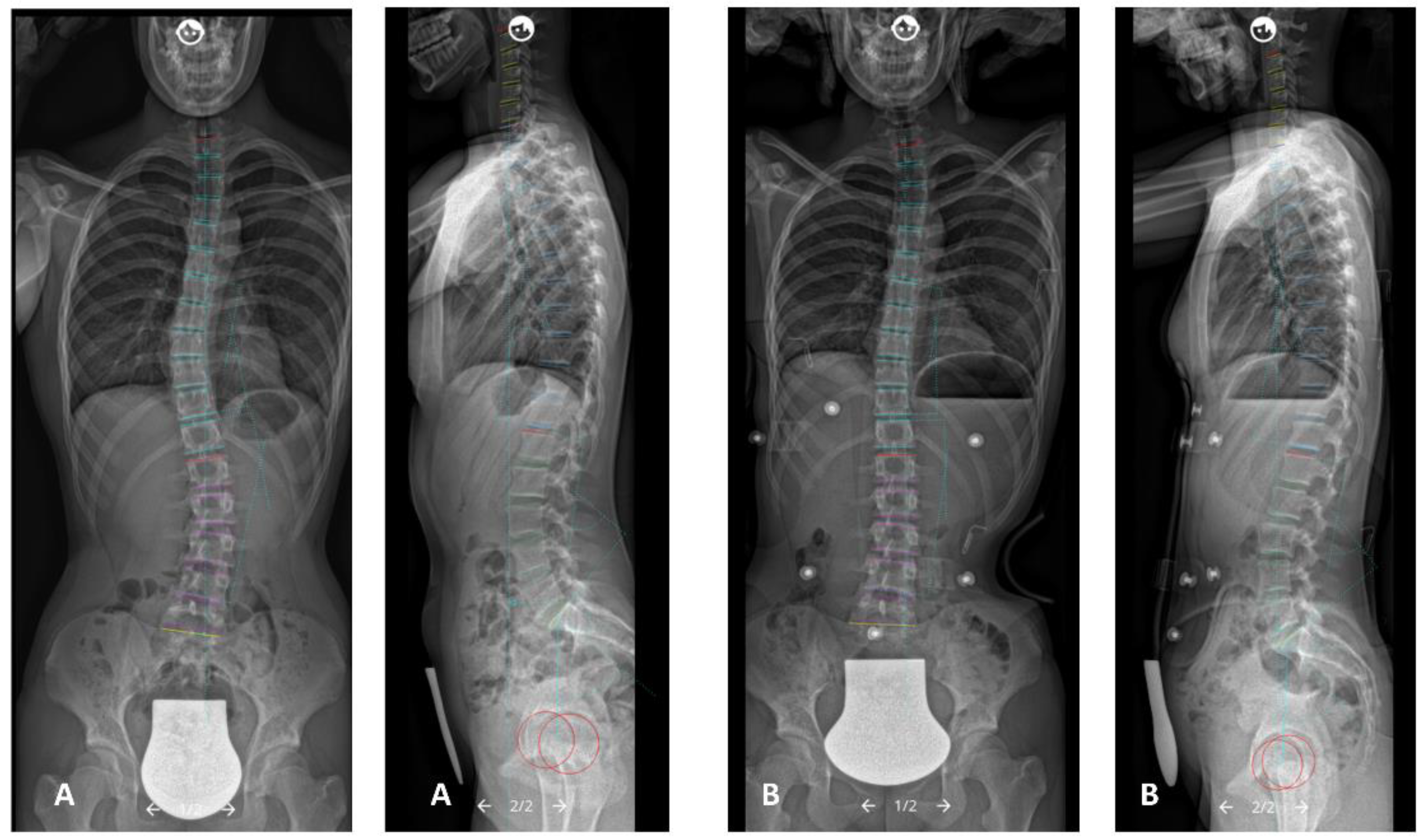 Cheneau Concept - Scoliosis Bracing Innovations🎊 Experimente a emoção ... Cheneau Concept - Scoliosis Bracing Innovations🎊 Experimente a emoção ...