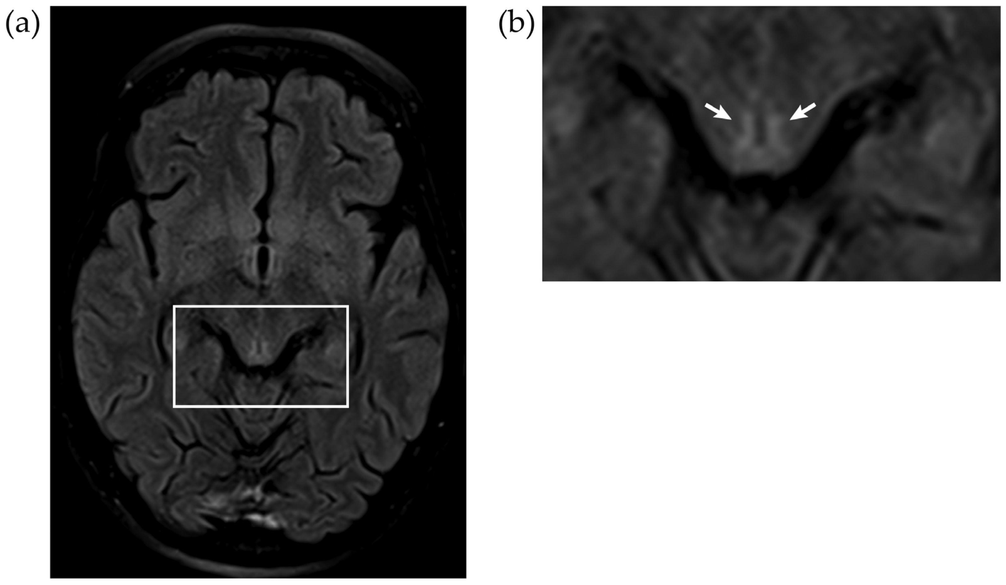 Coordination and Cognition in Pure Nutritional Wernicke’s ...