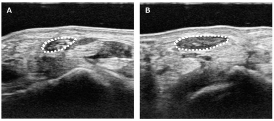 Potential Relationships between the Median Nerve Cross-Sectional Area ...