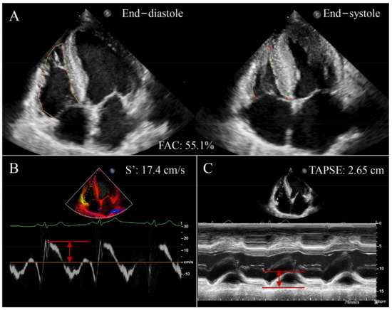 Clinical Usefulness of Right Ventricle–Pulmonary Artery Coupling in ...