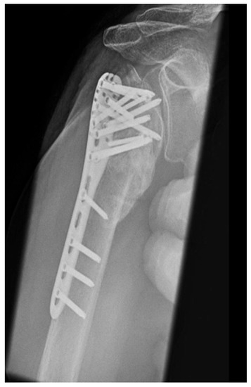 JCM | Free Full-Text | It Is Always the Same—A Complication ...