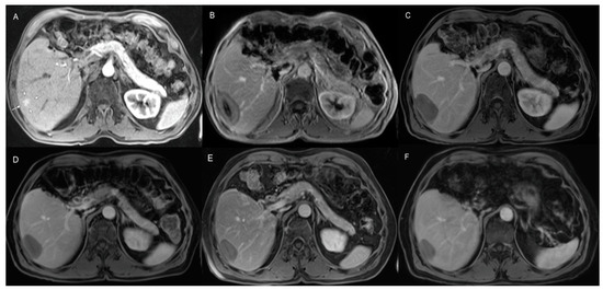 Microwave Ablation of Recurrent Hepatocellular Carcinoma after Curative Surgical Resection