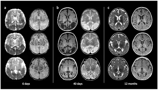 Glycaemic Imbalances in Seizures and Epilepsy of Paediatric Age: A Literature Review