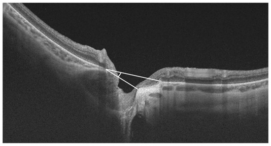 Update on the Utility of Optical Coherence Tomography in the Analysis ...