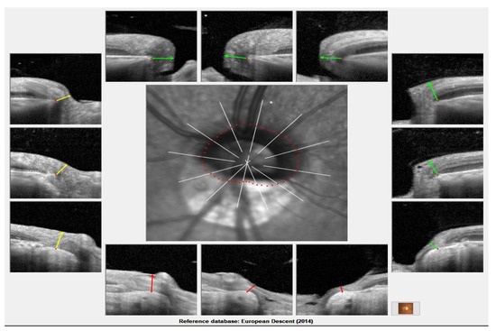 Update on the Utility of Optical Coherence Tomography in the Analysis ...