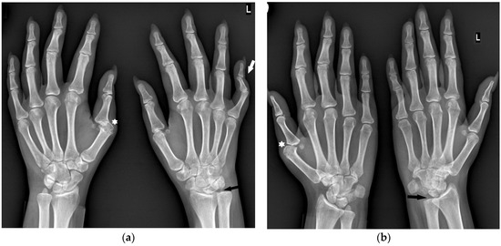 JCM | Free Full-Text | Hand and Wrist Involvement in Seropositive ...