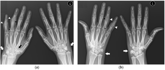 Hand and Wrist Involvement in Seropositive Rheumatoid Arthritis ...