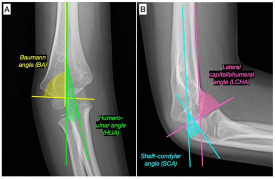 Guided Growth for the Treatment of Cubitus Varus in Children: Medium ...