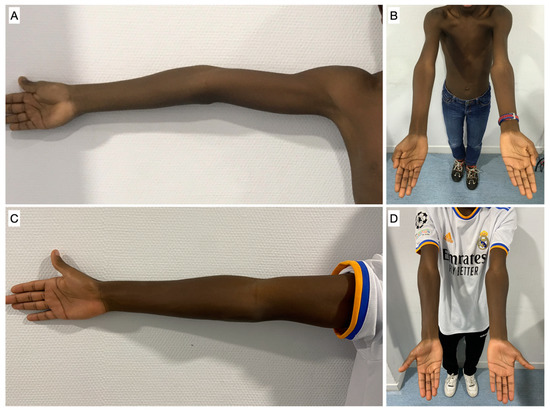 Guided Growth for the Treatment of Cubitus Varus in Children: Medium ...