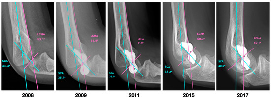 Guided Growth for the Treatment of Cubitus Varus in Children: Medium ...