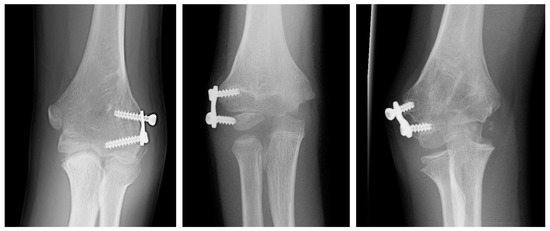 Guided Growth for the Treatment of Cubitus Varus in Children: Medium ...