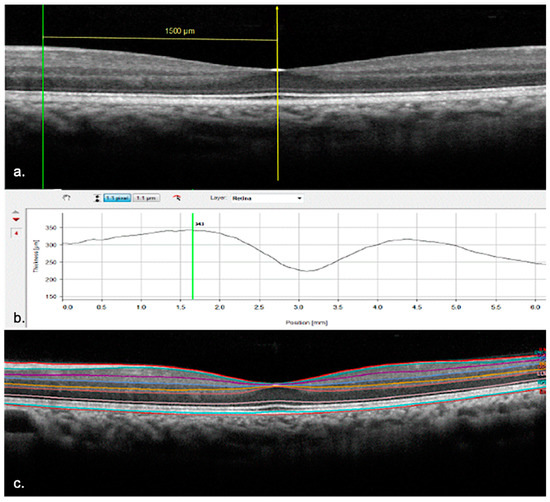 Quantitative and Qualitative Assessments of Retinal Structure with ...