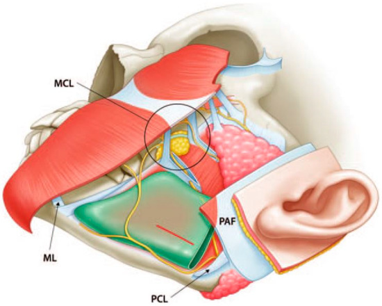 Mandible Angle Resection with the Retroauricular Approach