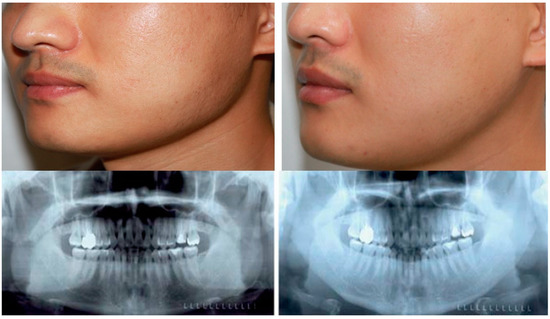 JCM | Free Full-Text | Mandible Angle Resection with the Retroauricular ...