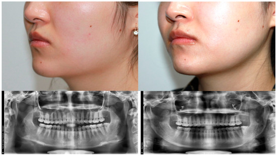 Mandible Angle Resection with the Retroauricular Approach