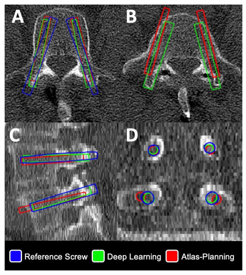 Automatic Planning Tools for Lumbar Pedicle Screws: Comparison and ...