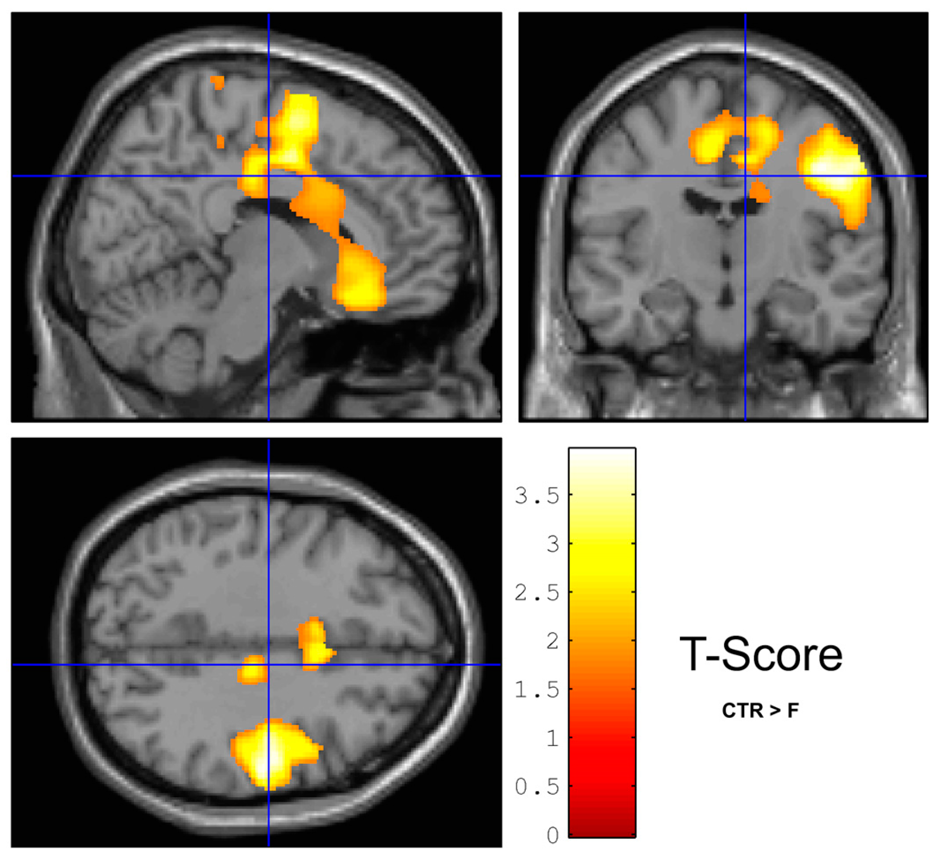 Resistance Training Increases White Matter Density in Frail Elderly Women