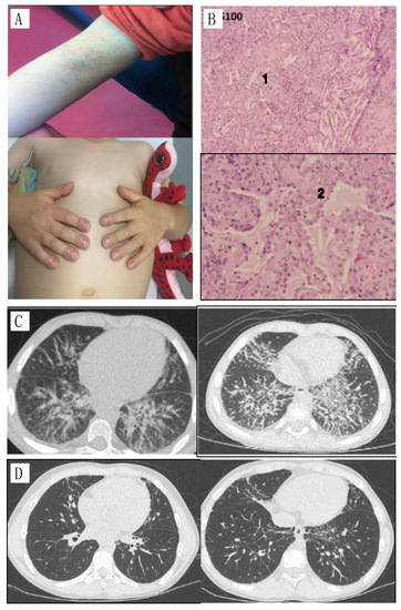 Rescue of Pap-Mas in Systemic JIA Using Janus Kinase Inhibitors, Case ...
