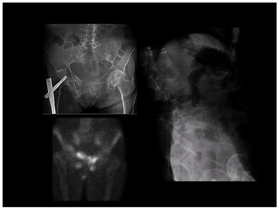 Osteomalacia in Adults: A Practical Insight for Clinicians
