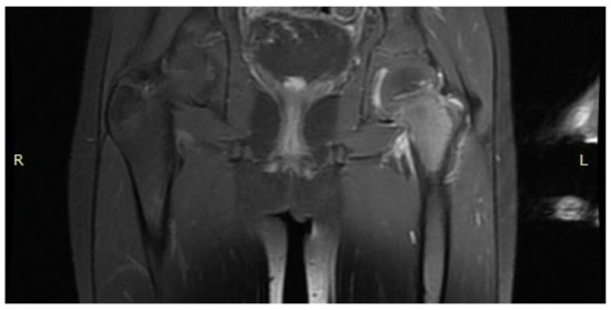 Osteoid Osteoma, a Diagnostic Problem: A Series of Atypical and ...
