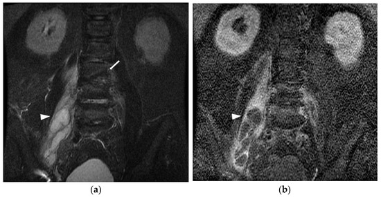 Clinical Characteristics and In-Hospital Outcomes in Patients with ...