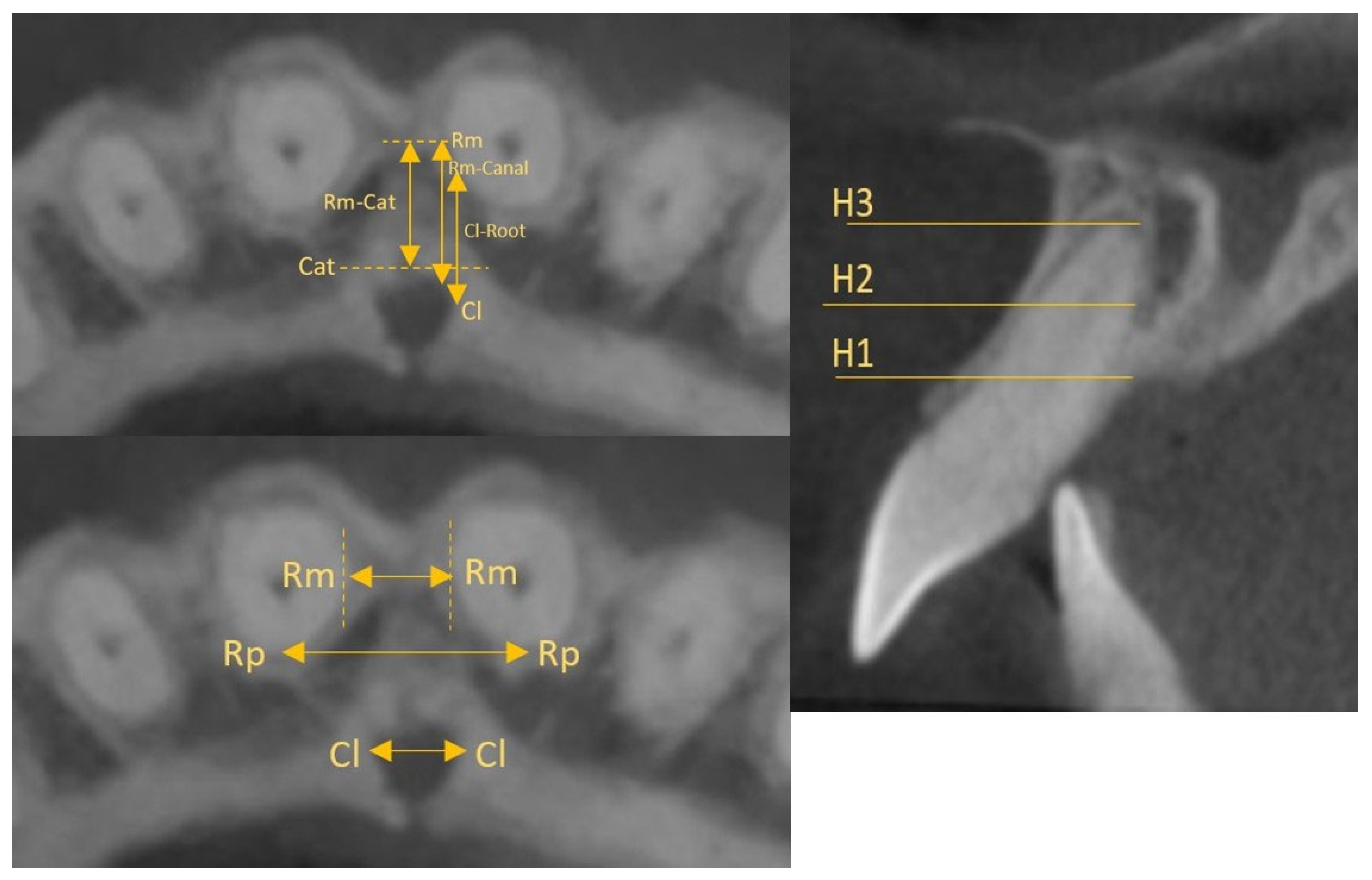 The Assessment of the Rank of Torque Control during Incisor Retraction ...