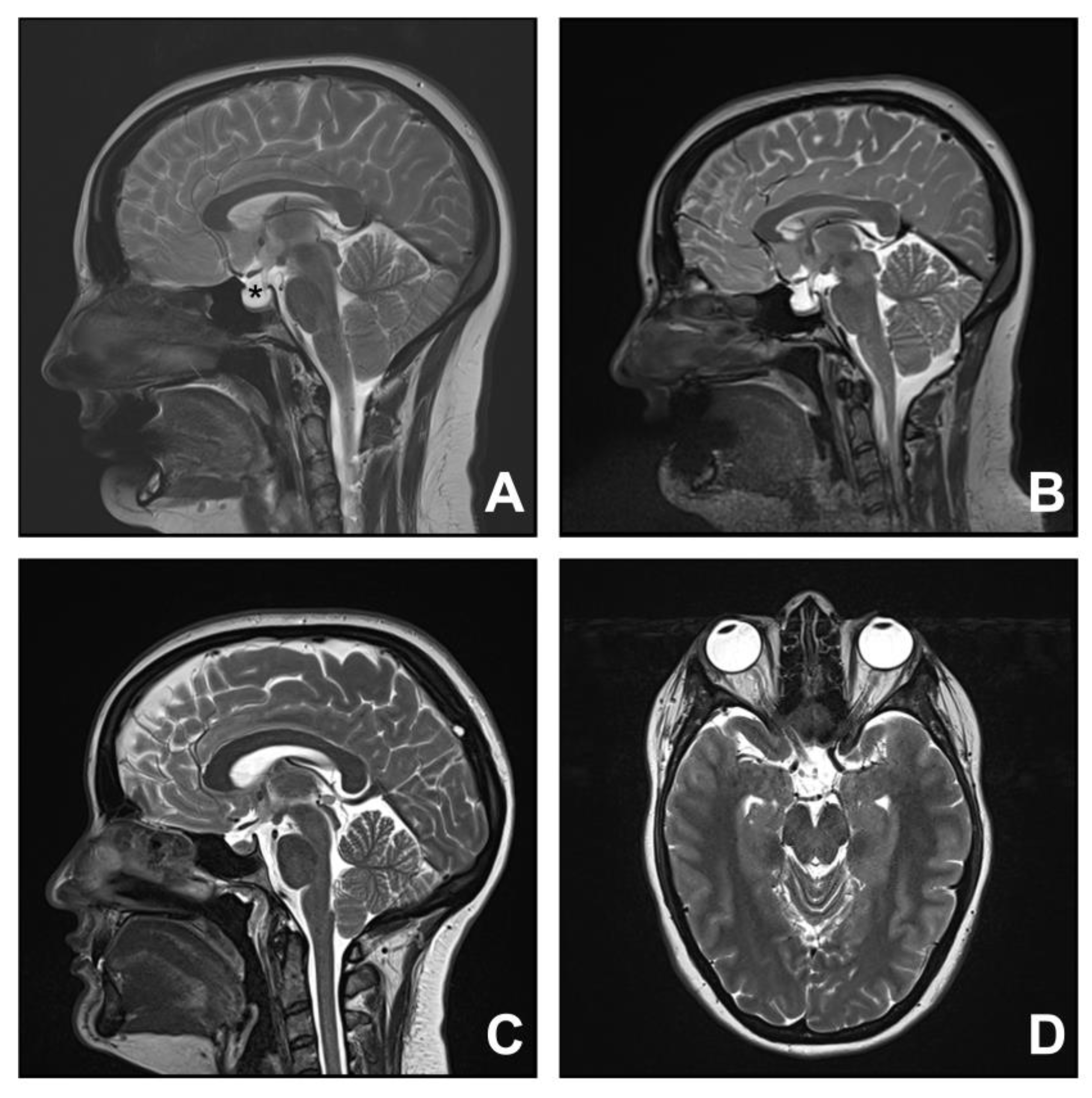 Tonsils Of Cerebellum