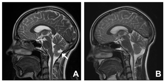 JCM | Free Full-Text | Cerebellar Tonsillar Descent Mimicking Chiari ...