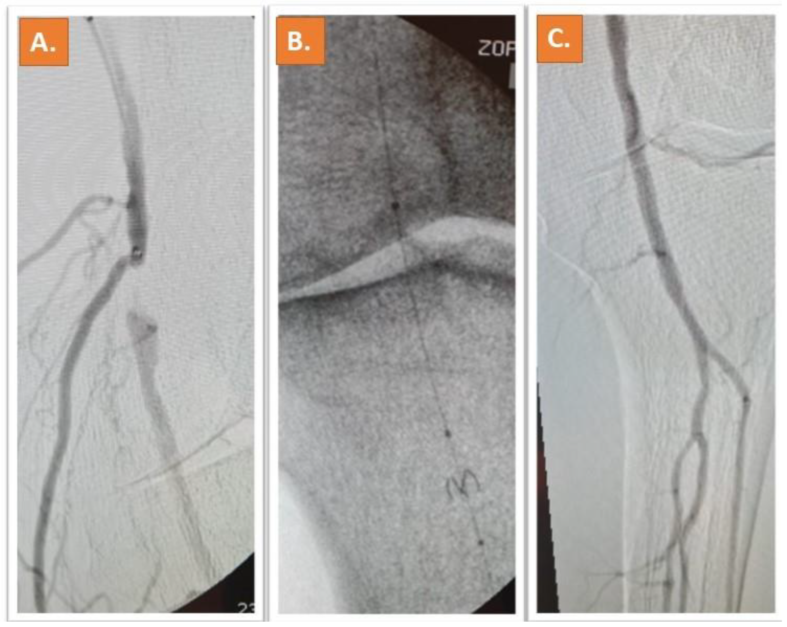 JCM | Free Full-Text | Periprocedural Outcomes of Rotational Atherectomy-Assisted Balloon ...