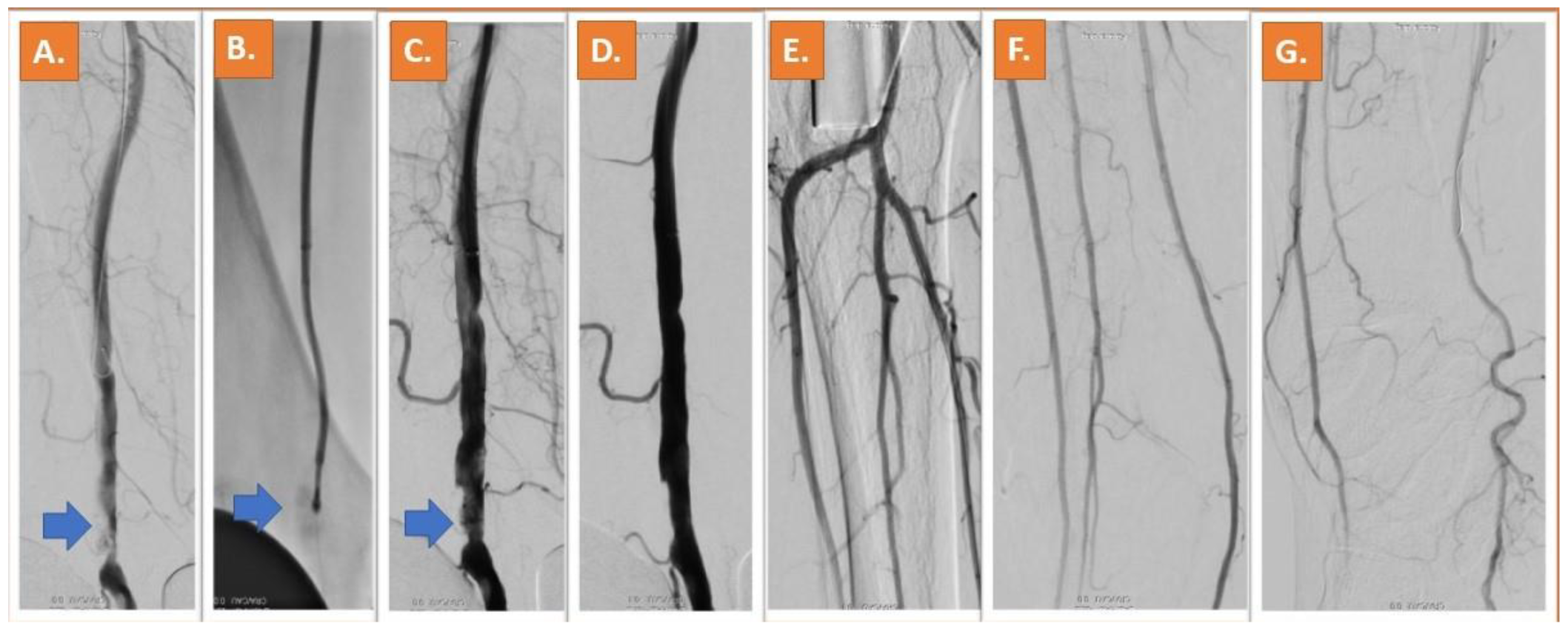 Periprocedural Outcomes of Rotational Atherectomy-Assisted Balloon ...
