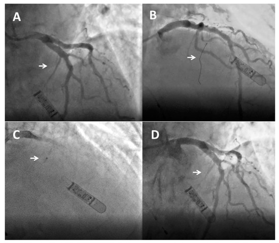 Alcohol Septal Ablation in Patients with Hypertrophic Obstructive ...