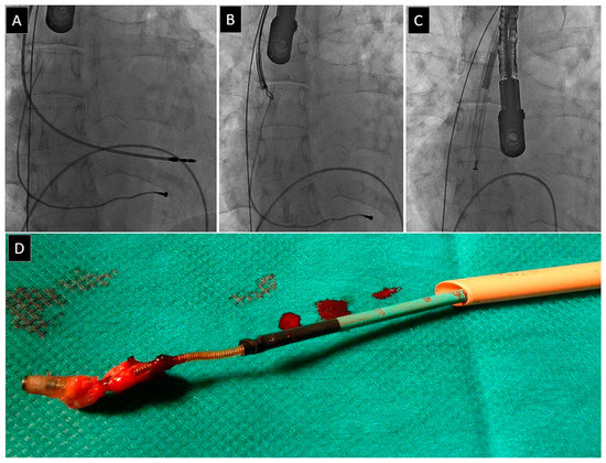 Unexpected Procedure Difficulties Increasing the Complexity of ...