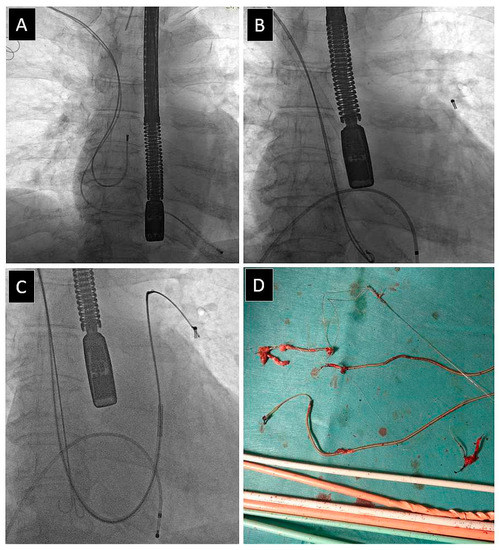 Unexpected Procedure Difficulties Increasing the Complexity of ...