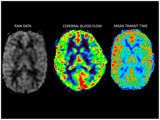 White-Matter Lesions and Cortical Cerebral Blood Flow Evaluation by 3D ...