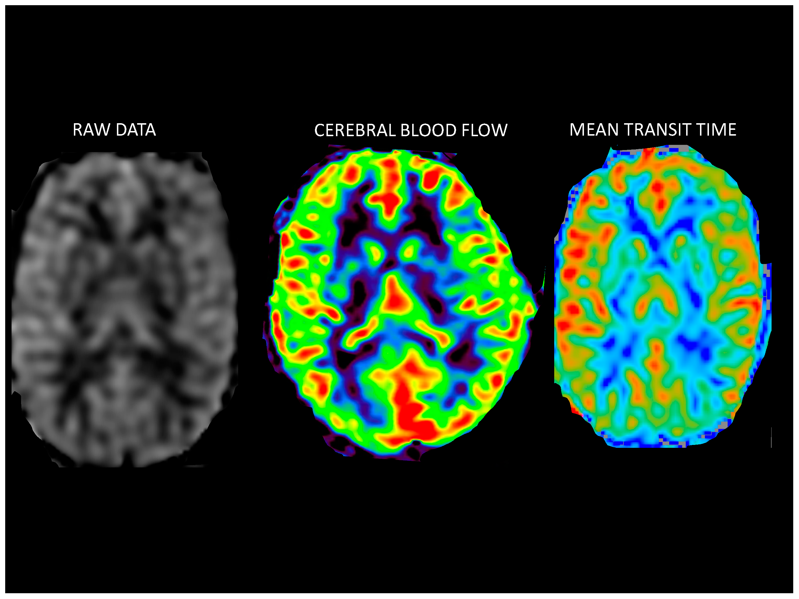 White-Matter Lesions and Cortical Cerebral Blood Flow Evaluation by 3D ...
