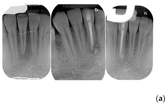 Outcomes of Endodontic-Treated Teeth Obturated with Bioceramic Sealers ...