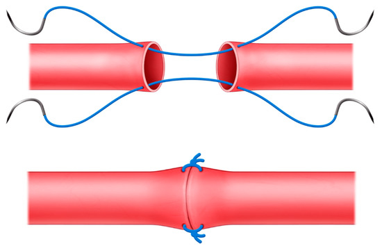 What Is the Minimum Number of Sutures for Microvascular Anastomosis ...