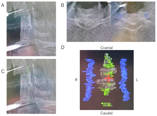 JCM | Free Full-Text | Augmented Reality Support for Anterior ...