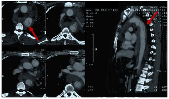 Blunt Thoracic Aortic Injury