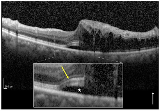 Visual Prognostic Factors in Eyes with Subretinal Fluid Associated with ...