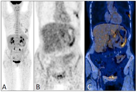 Performance of [18F]FDG-PET/CT Imaging in First Recurrence of Invasive ...