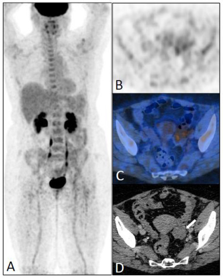 Performance of [18F]FDG-PET/CT Imaging in First Recurrence of Invasive ...