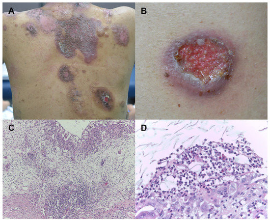 Management of Steroid-Induced Glaucoma in a Patient with Pyoderma ...