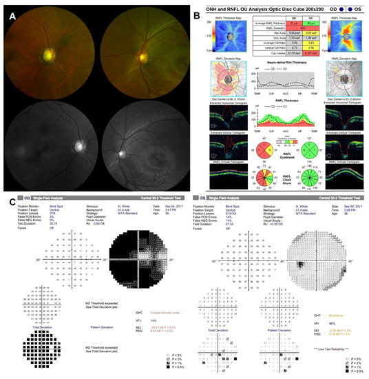 Management of Steroid-Induced Glaucoma in a Patient with Pyoderma ...
