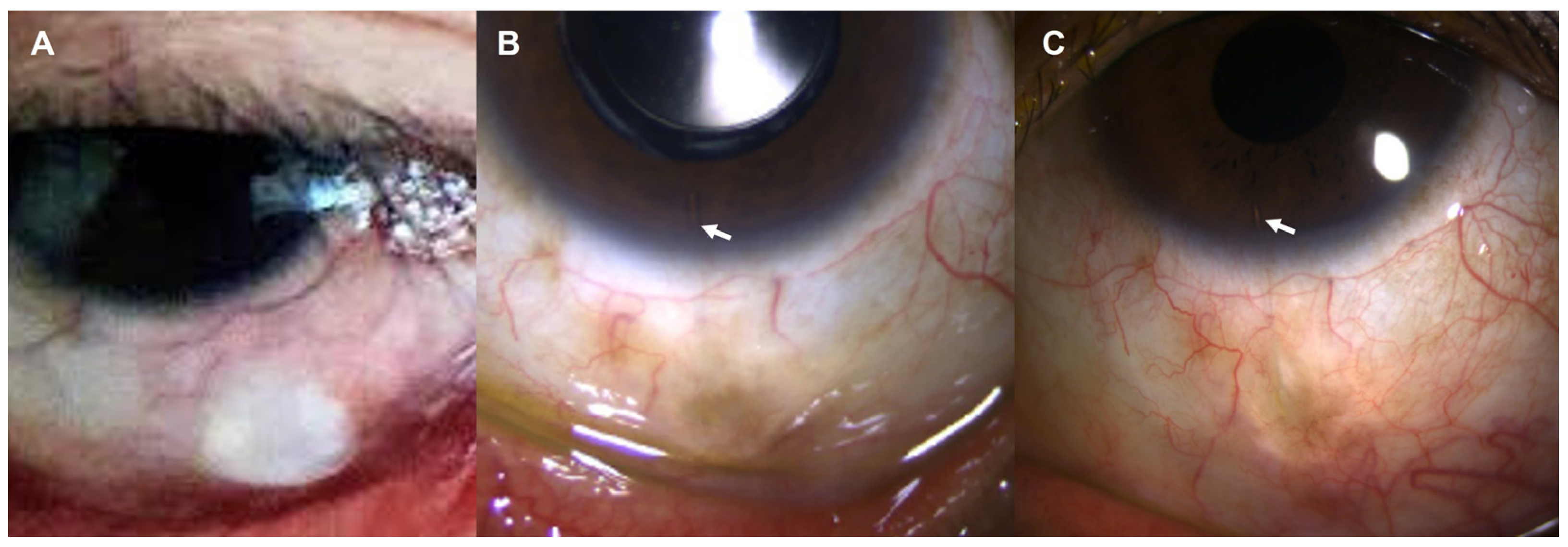 Management of Steroid-Induced Glaucoma in a Patient with Pyoderma ...