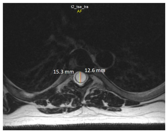 Amyotrophic Lateral Sclerosis Mimic Syndrome in a 24-Year-Old Man with ...