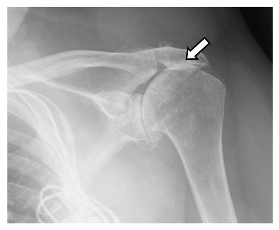 JCM | Free Full-Text | Update on Shoulder Arthroplasties with Emphasis ...
