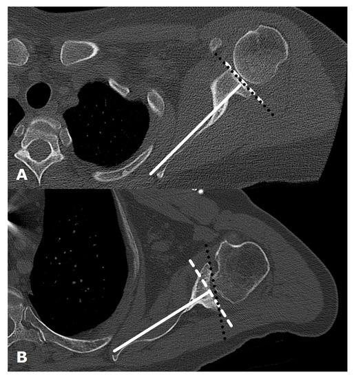 Update on Shoulder Arthroplasties with Emphasis on Imaging